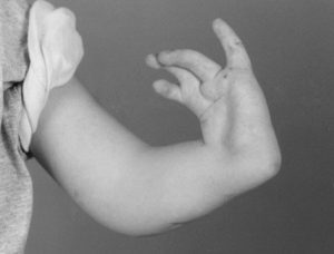 Clinical Care of Hand and Arm Abnormalities in Fanconi Anemia - Fanconi ...